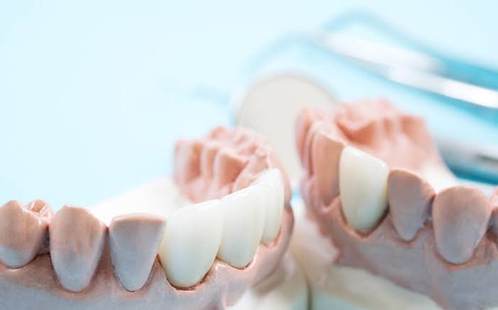 Prosthodontics - Crowns Bridges & Dentures
