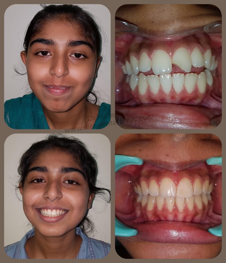 Smile correction