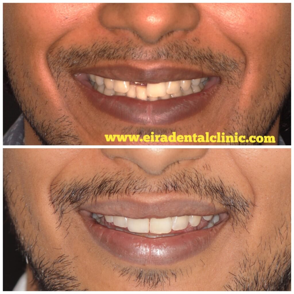 Digital crowns and bridges for missing teeth