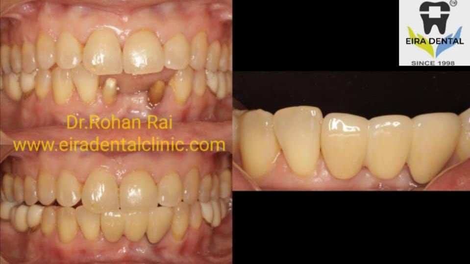 Digital crowns and bridges for missing teeth