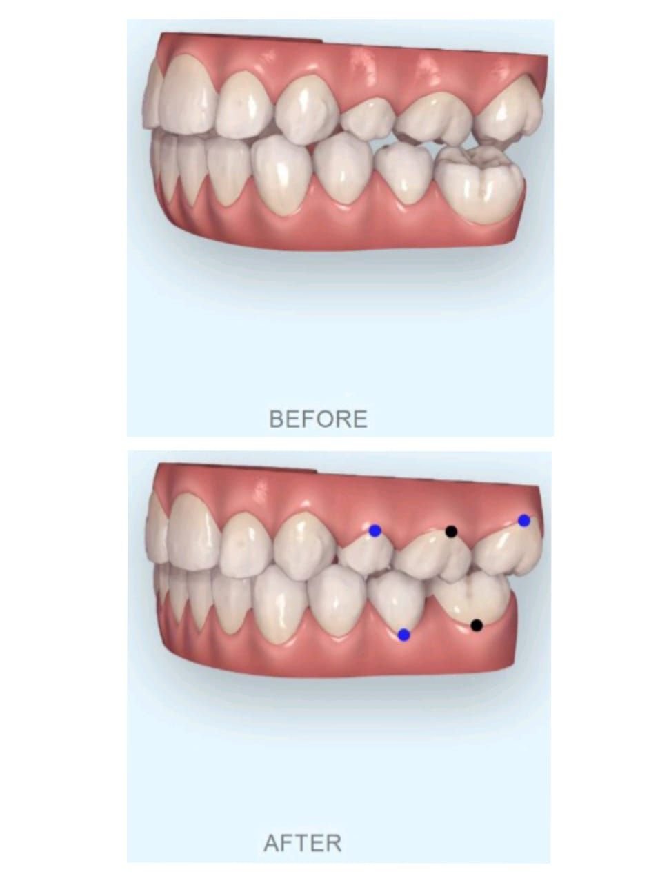 Understanding Crossbites: Anterior and Posterior